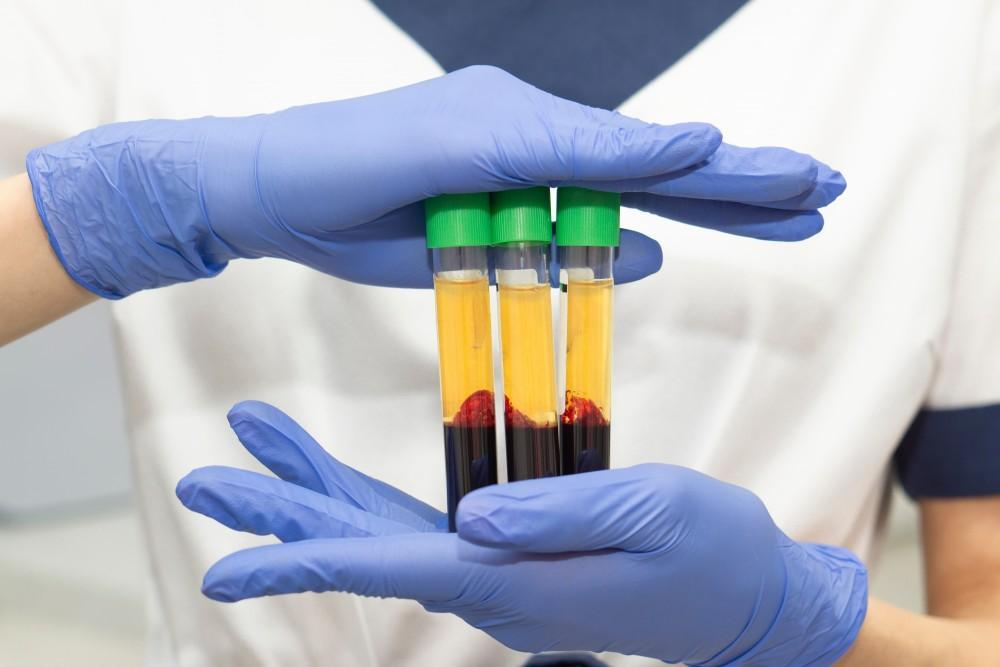plasma therapy : 1 of the best cure to cancer | gottyou